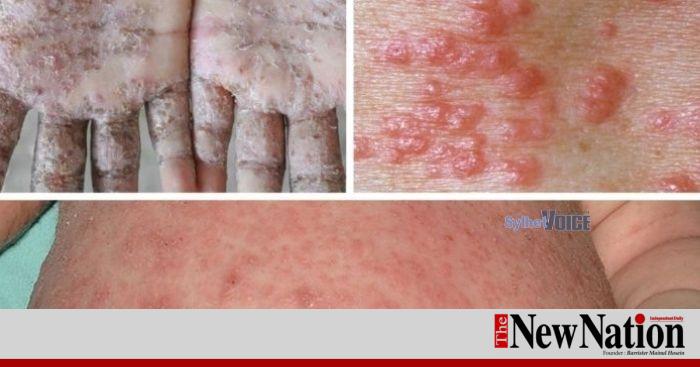 Skin disease scabies spread in Sylhet